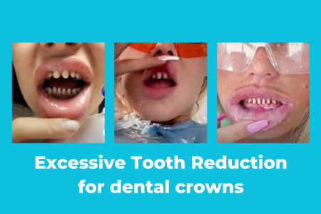 Protecting Your Smile from 'Turkey Teeth' Gone Wrong